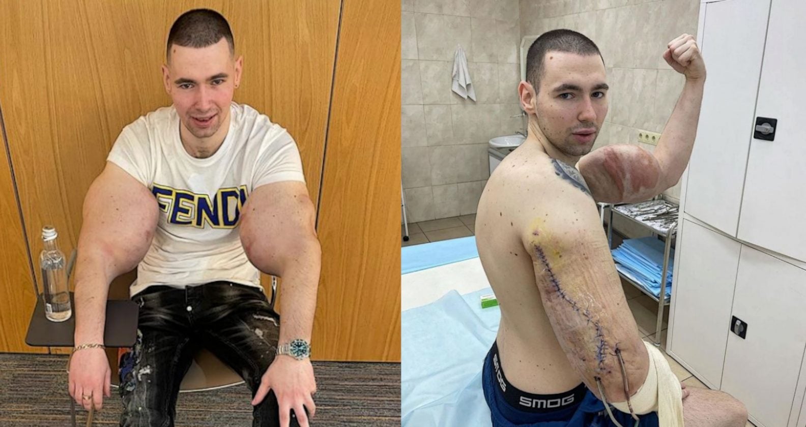 Kirill Tereshin Has Second Surgery to Get "Rotten Muscle" and Oil ...