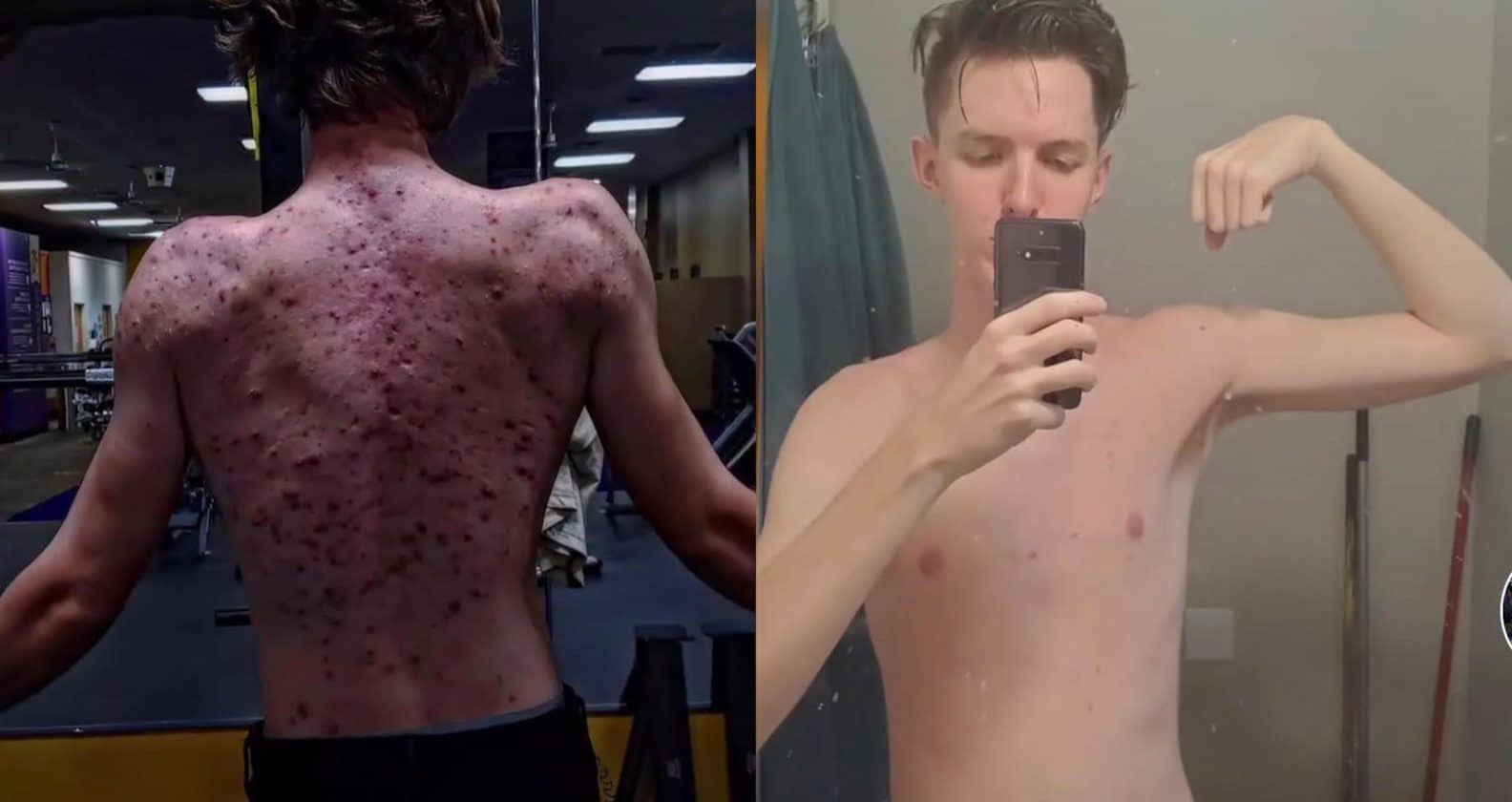 Skinny TikToker Shows Insane Backne After Four Months Of Steroid Use